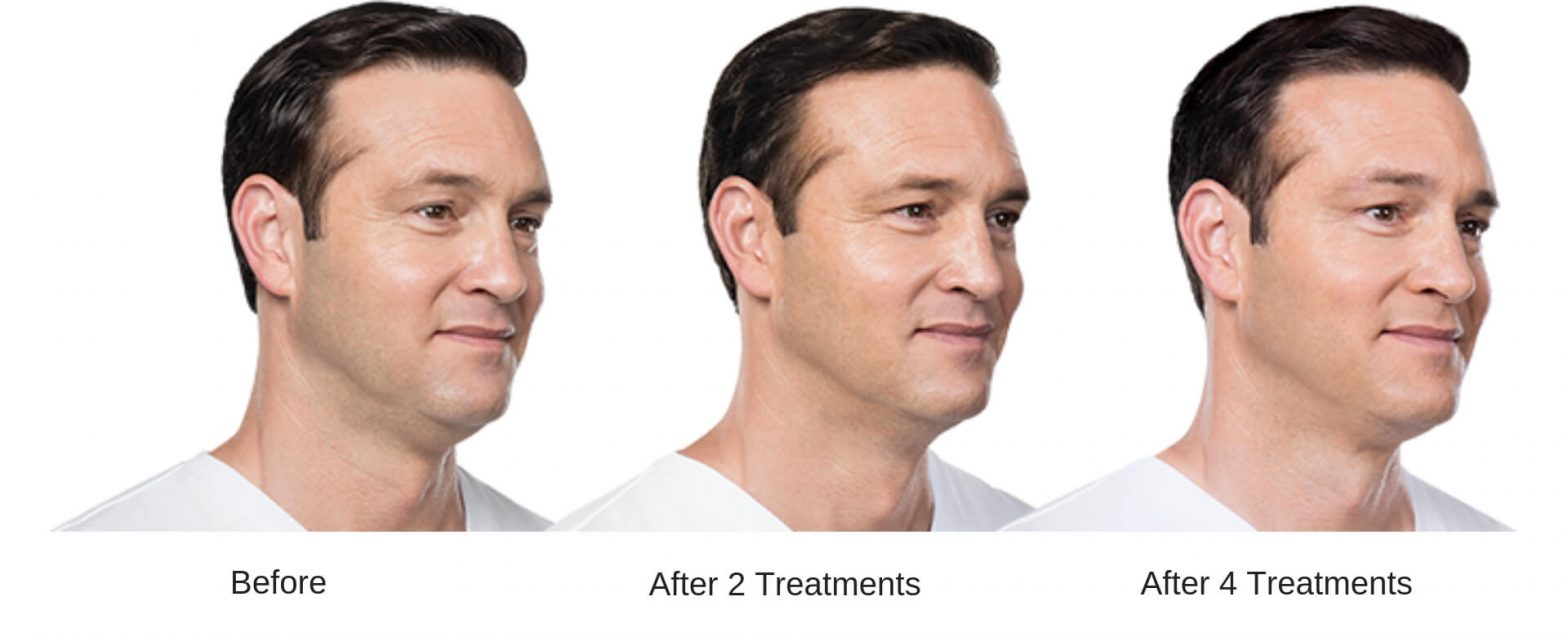 KyBella Fort Worth, TX | Fat Dissolving Injection in Colleyville