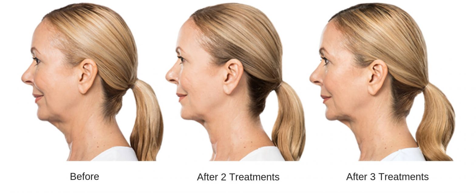 KyBella Fort Worth, TX | Fat Dissolving Injection in Colleyville