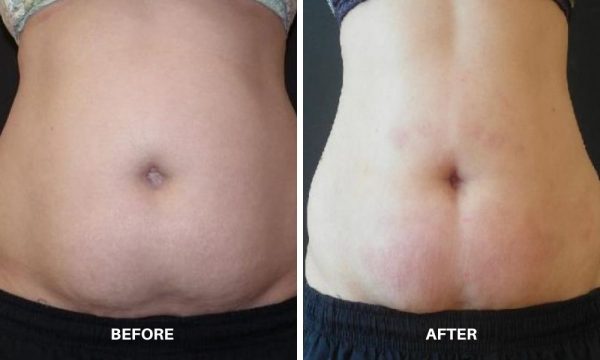 VelaShape | Cellulite Reduction | Dallas-Fort Worth, Texas