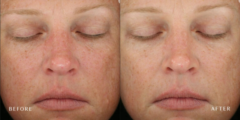 Diamond Glow Dallas, TX | Diamond Glow Facial Fort Worth