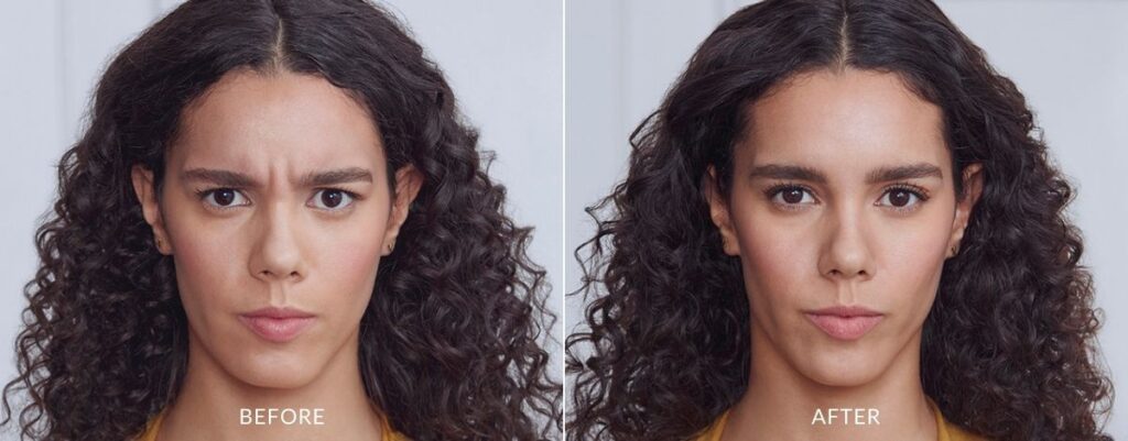 The Pros and Cons of Botox: Is It Worth It?