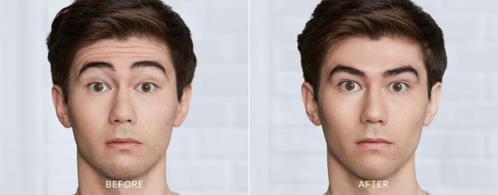 The Pros and Cons of Botox: Is It Worth It?