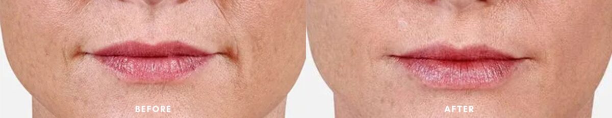 Juvéderm Lip Filler: Which is Best and How Long Do They Last?