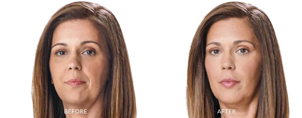 Where Is Juvéderm Injected? Learn About the Top 4 Filler areas